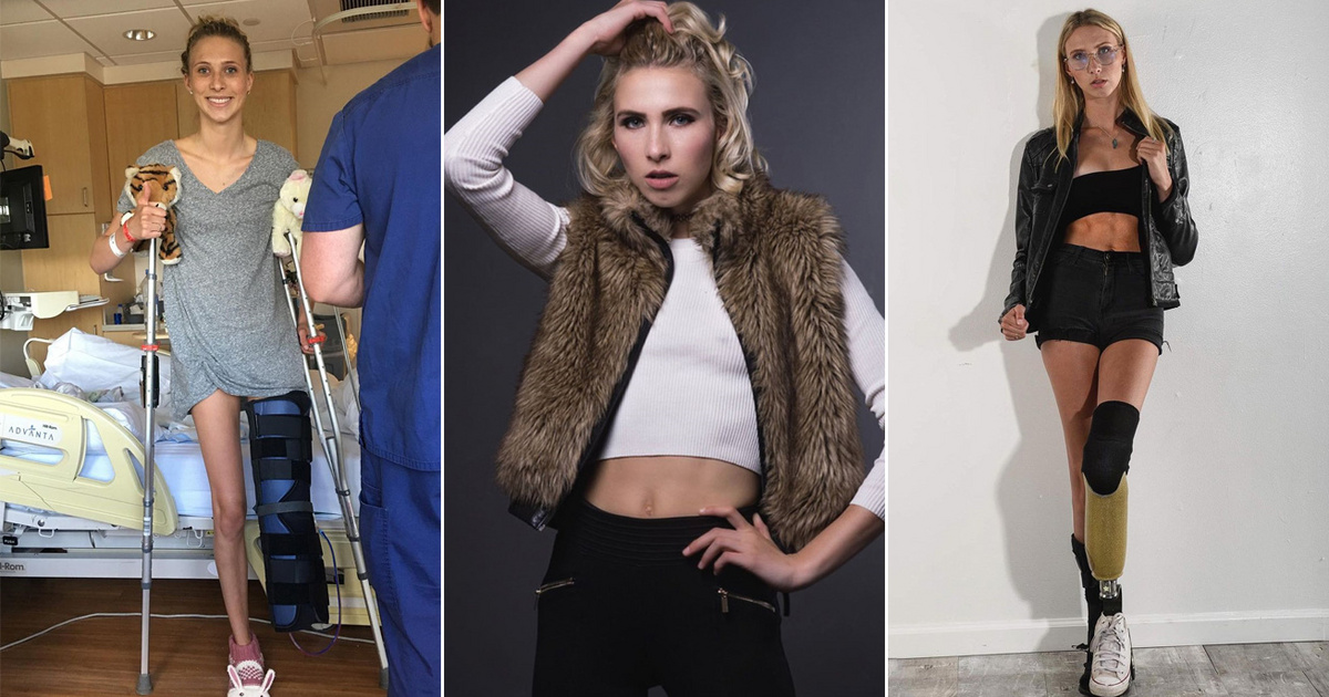 Balesete után elvesztette mindkét lábát, most modellként tündököl: a 24 ...