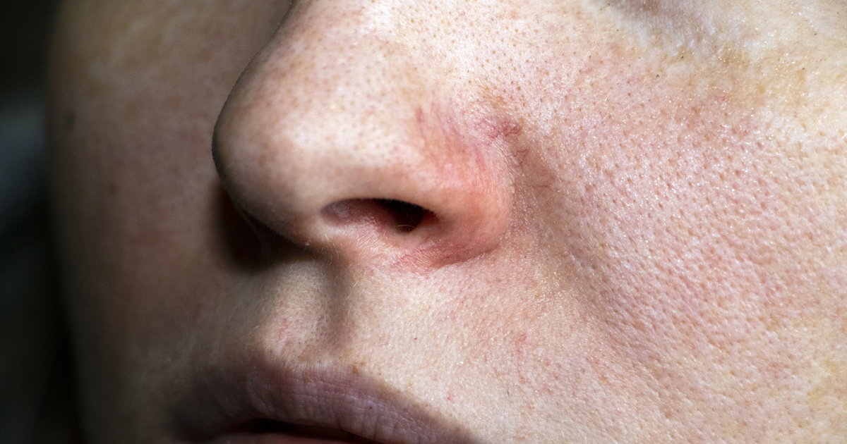 Amikor elsorvad az orr nyálkahártyája: így lehet felismerni az atrófiás ...