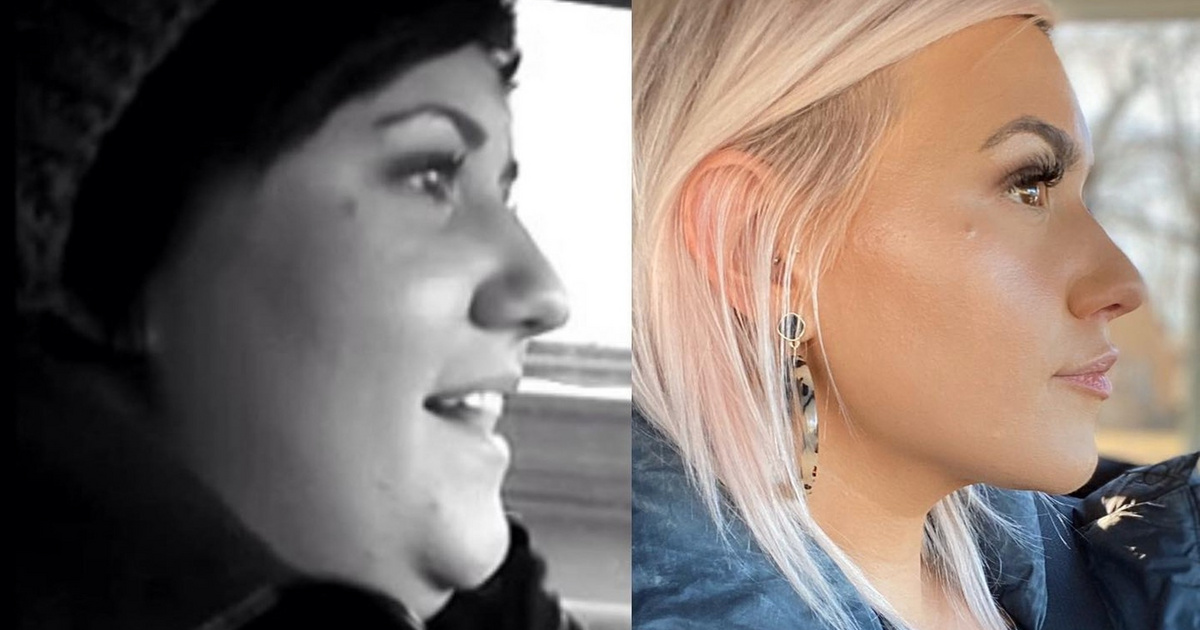 Elhagyta a cukrot az étrendjéből, 63 kilót fogyott: előtte-utána ...